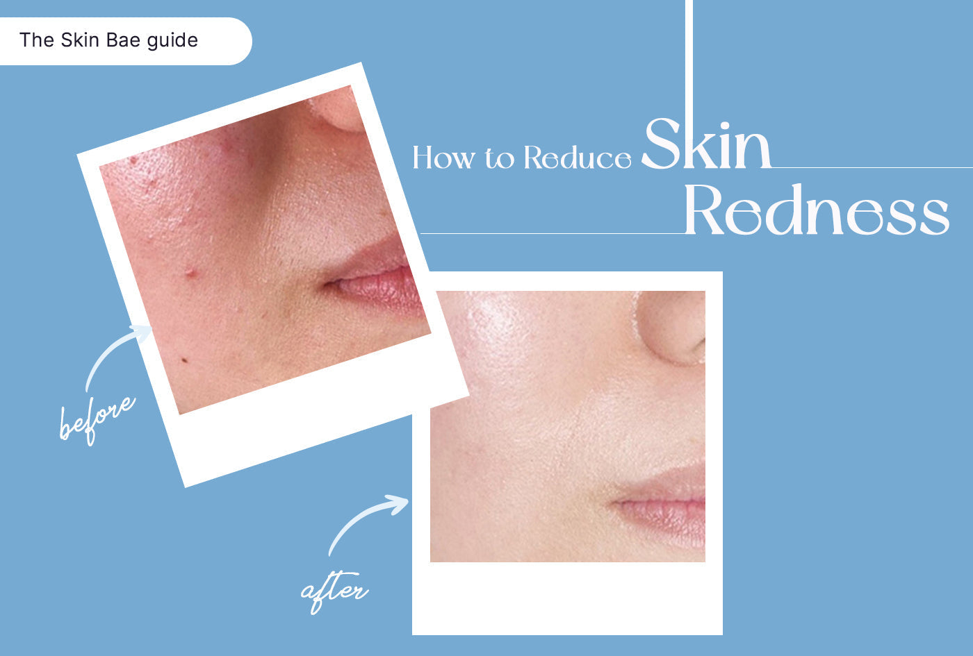 How to Reduce Skin Redness